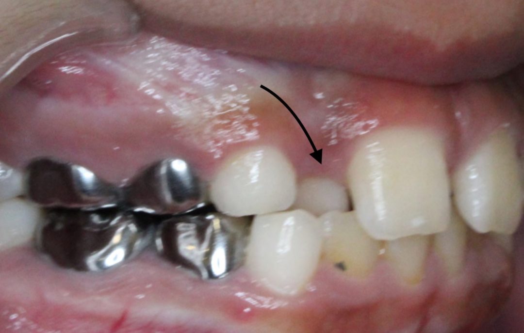 Phase 1 of Orthodontic Treatment | Shine Orthodontics | Thornton, CO